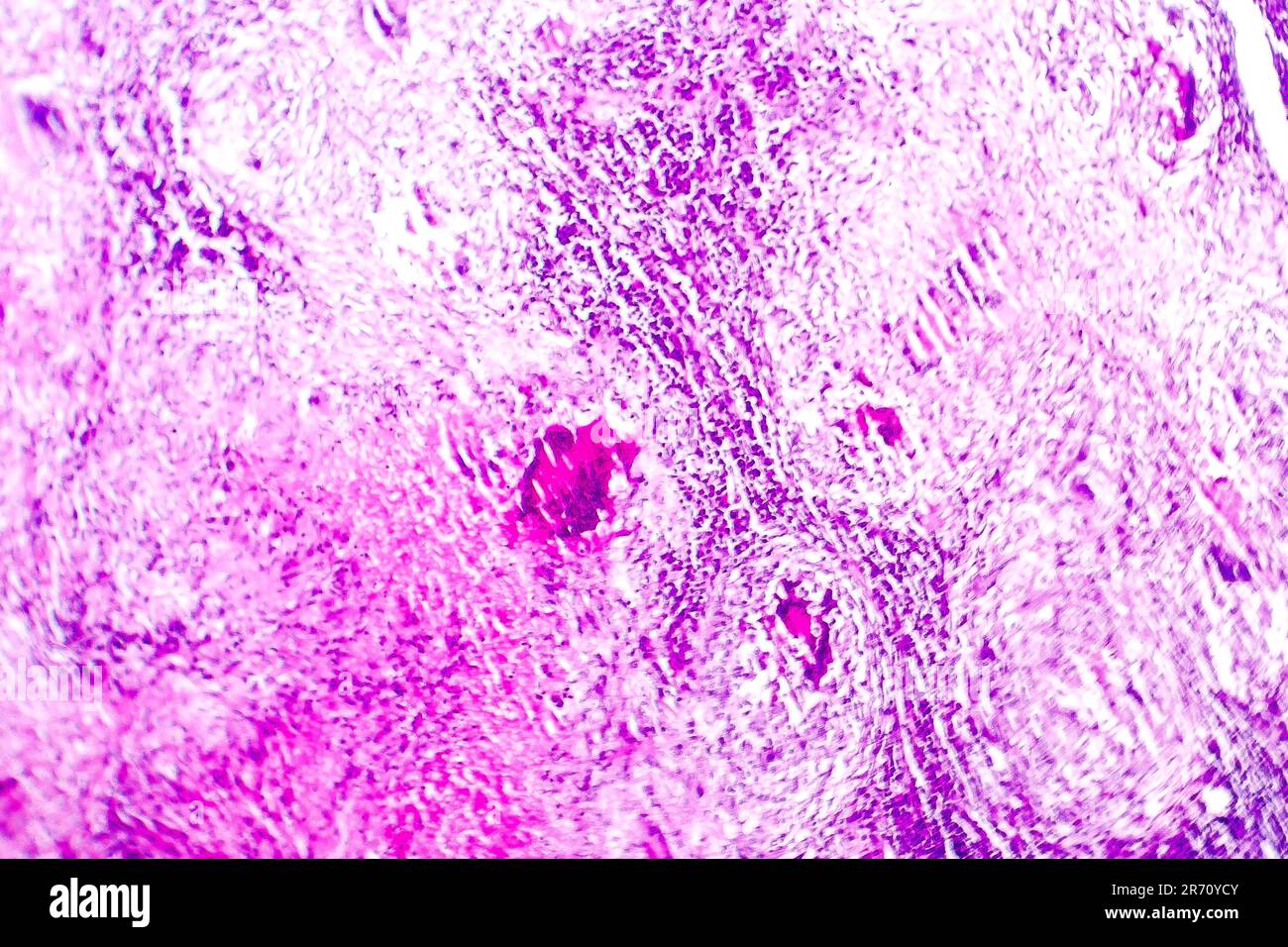 Caseous necrosis of lymphatic node, light micrograph, photo under ...