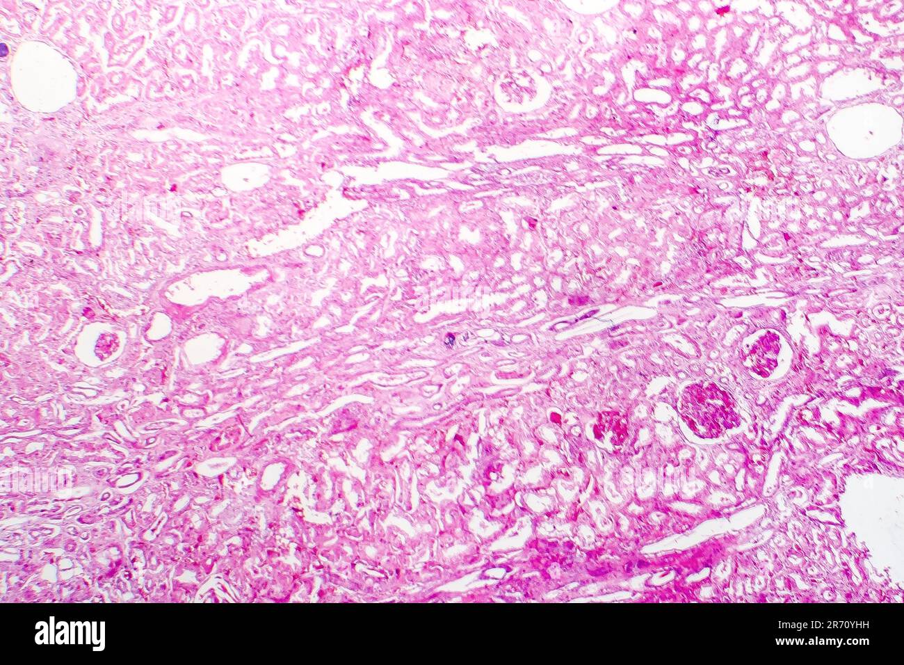 Edema of renal tubular epithelial cells in kidney failure, light ...