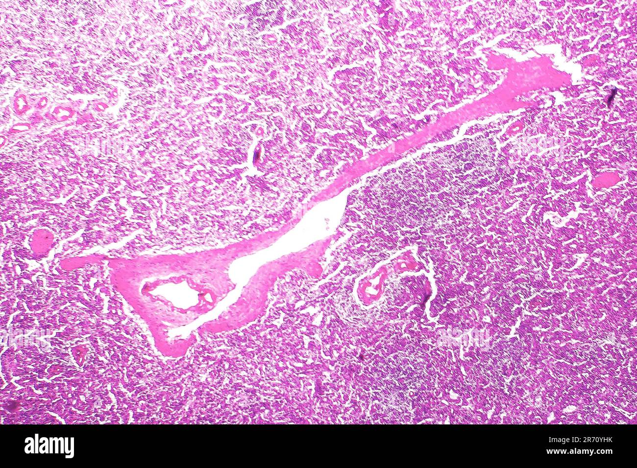 Splenic arterioles hyalinization, light micrograph, hematoxylin and ...