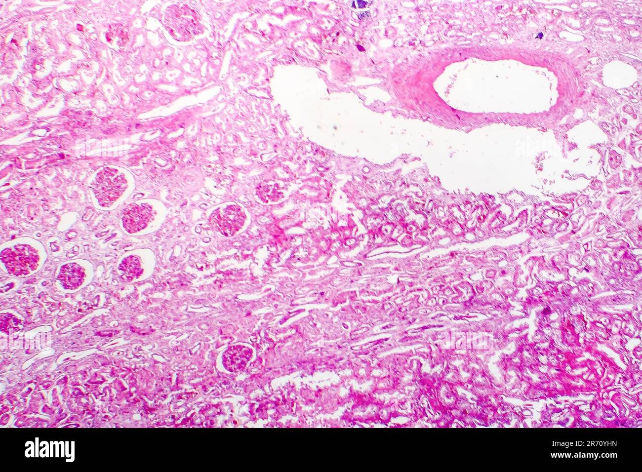 Edema of renal tubular epithelial cells in kidney failure, light ...