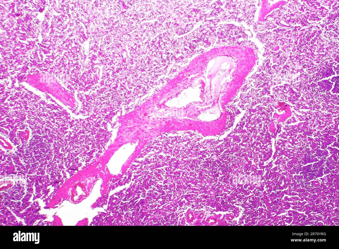 Splenic arterioles hyalinization, light micrograph, hematoxylin and ...
