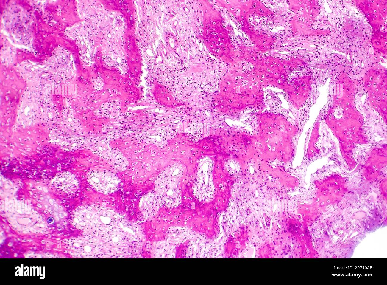 Histology of callus, a thickened skin made as a result of pressure ...