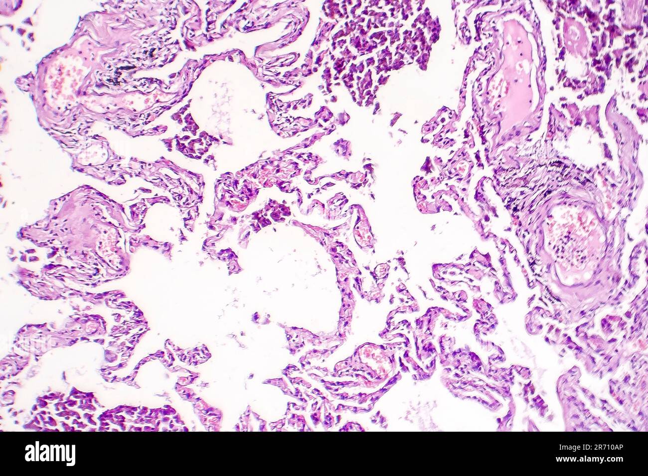 Chronic pulmonary congestion, light micrograph. Photo under microscope ...