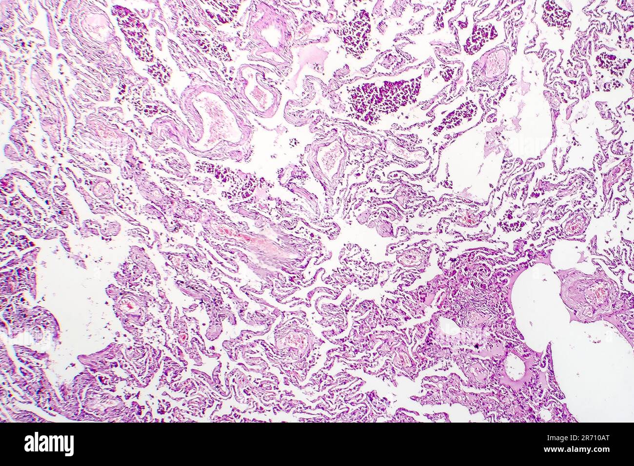Chronic pulmonary congestion, light micrograph. Photo under microscope ...