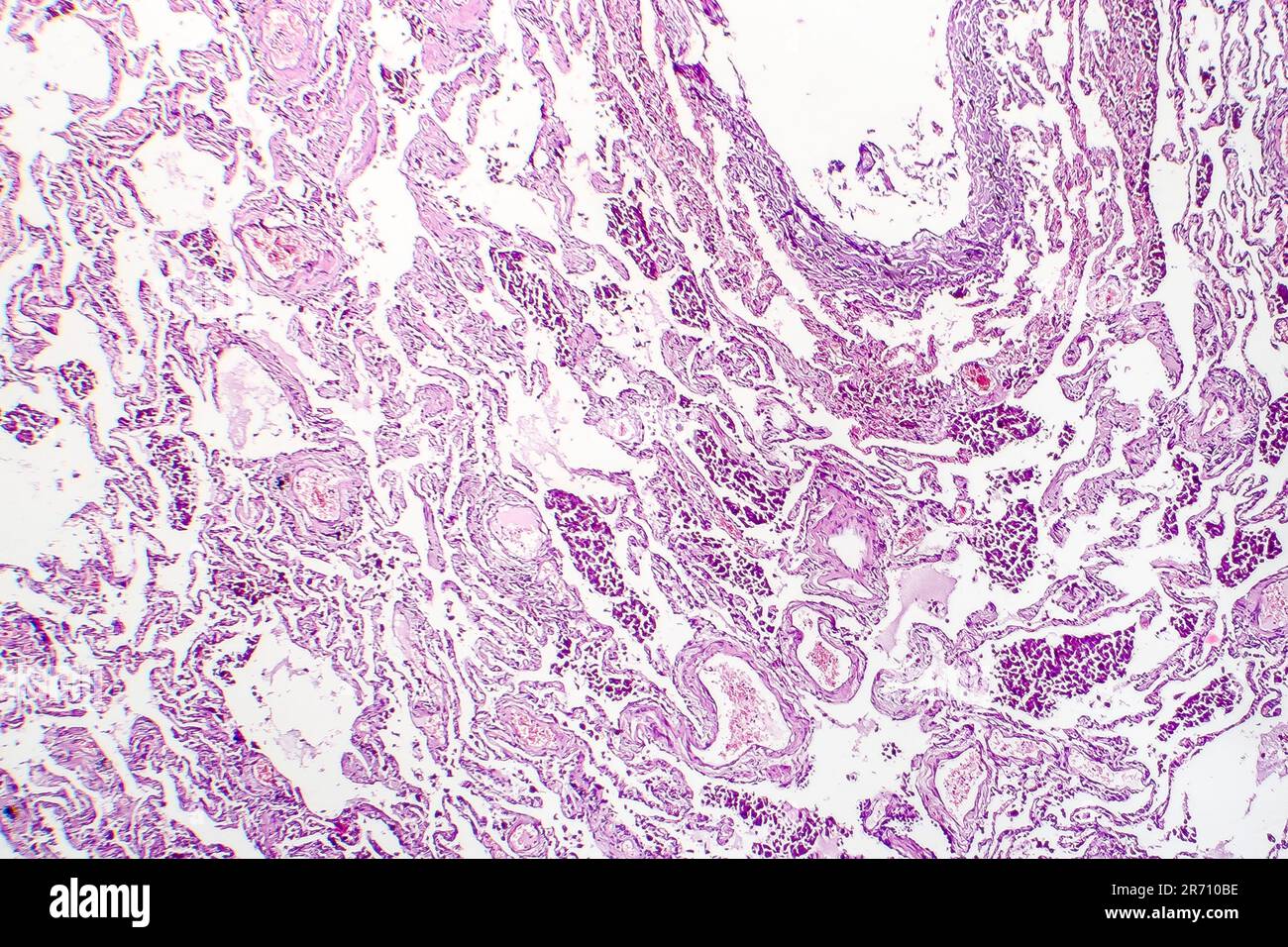 Chronic pulmonary congestion, light micrograph. Photo under microscope ...