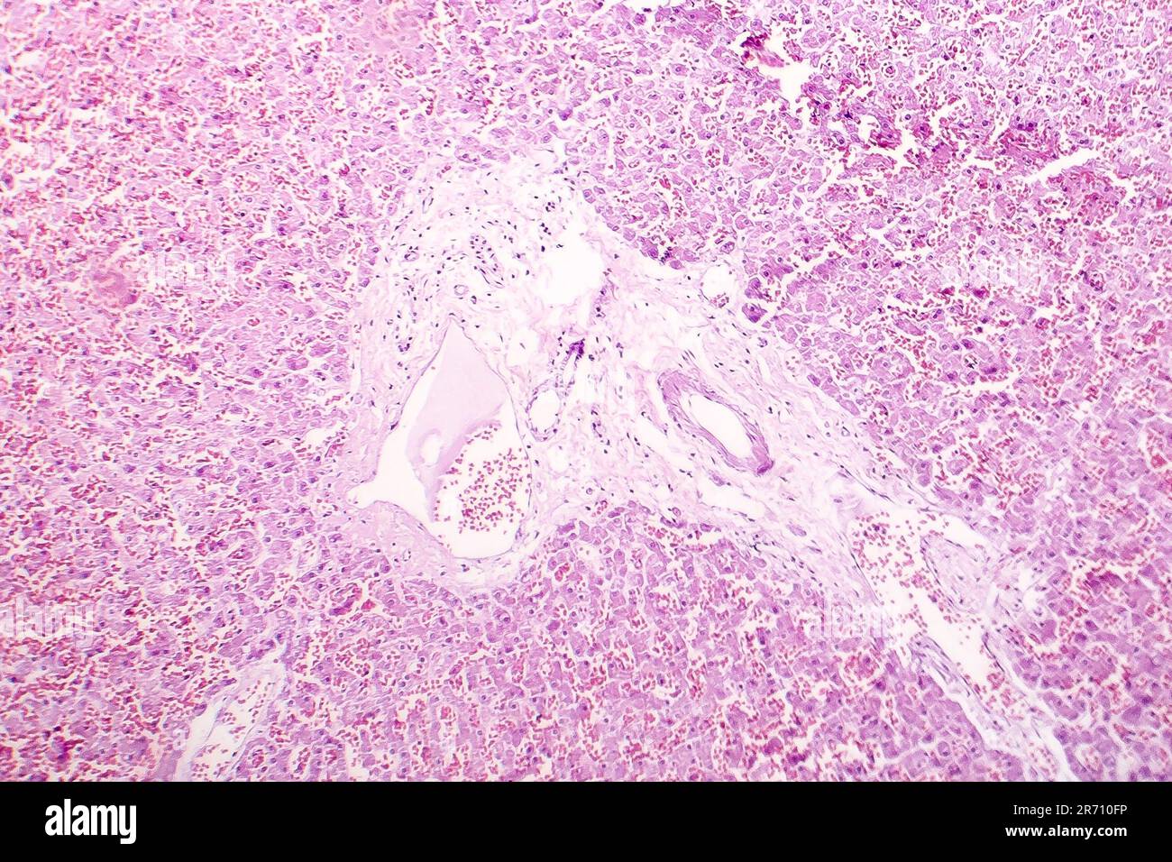 Congestive Heart Disease