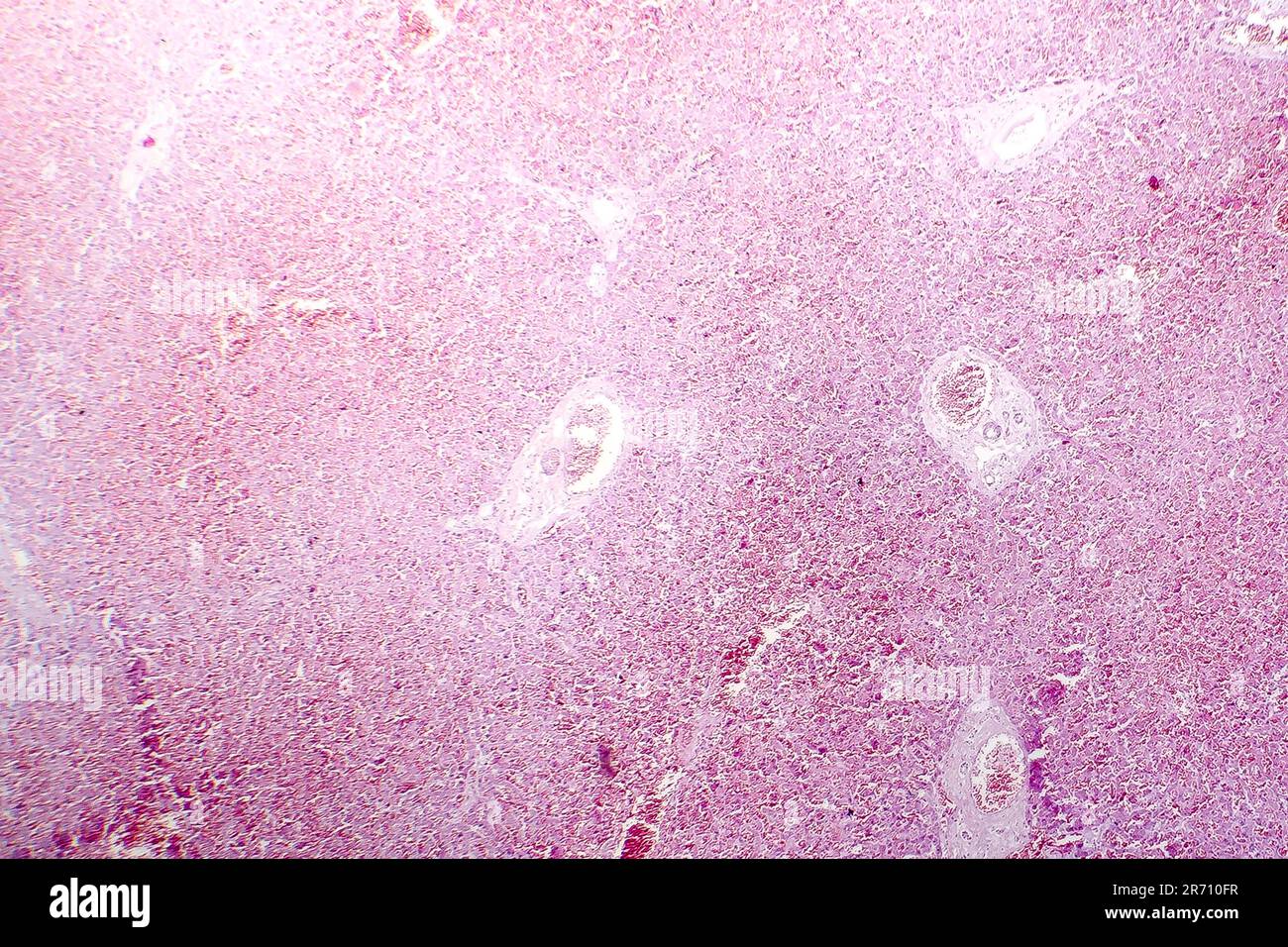 Congestive Heart Disease