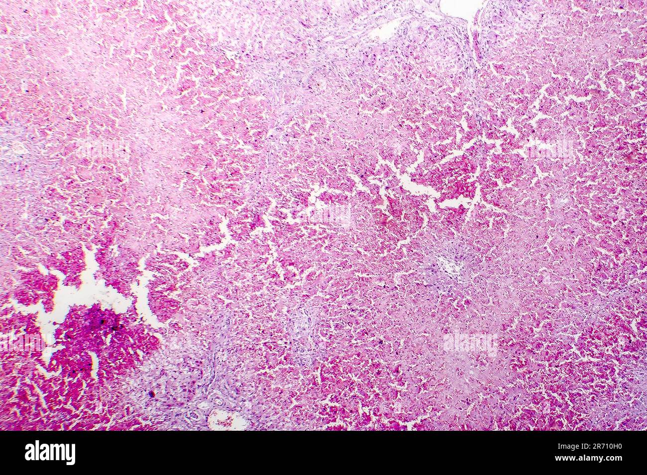 Congestive Heart Disease