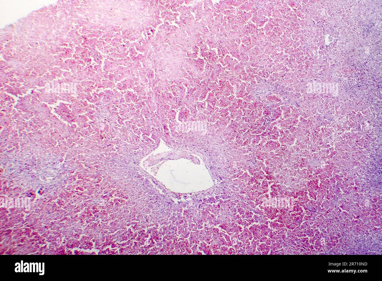 Chronic hepatic congestion, light micrograph, a congestion caused by ...
