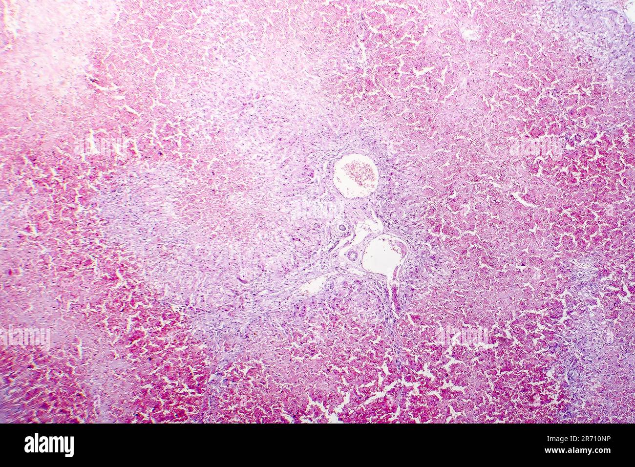 Congestive Heart Disease