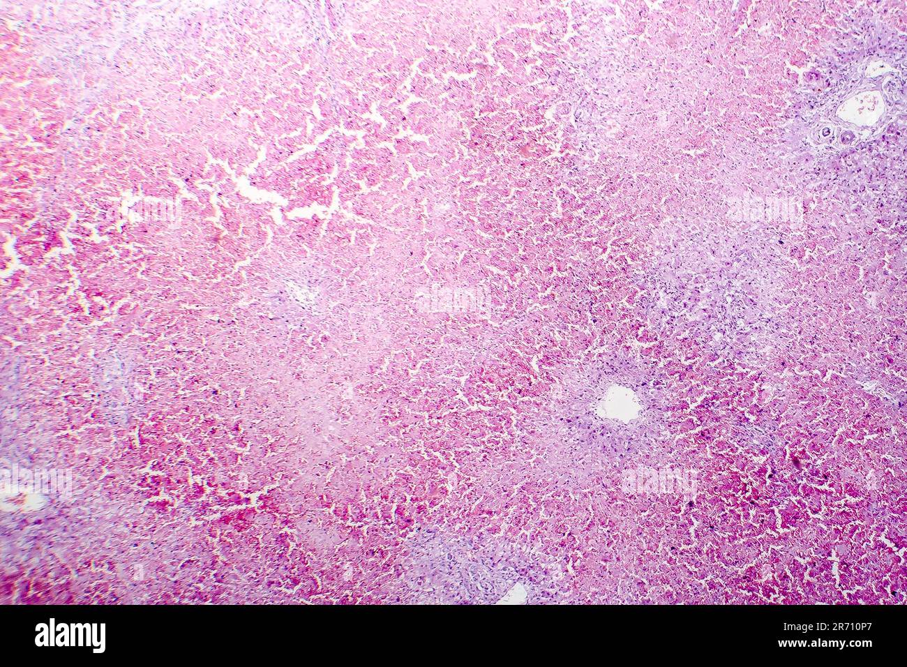 Congestive Heart Disease