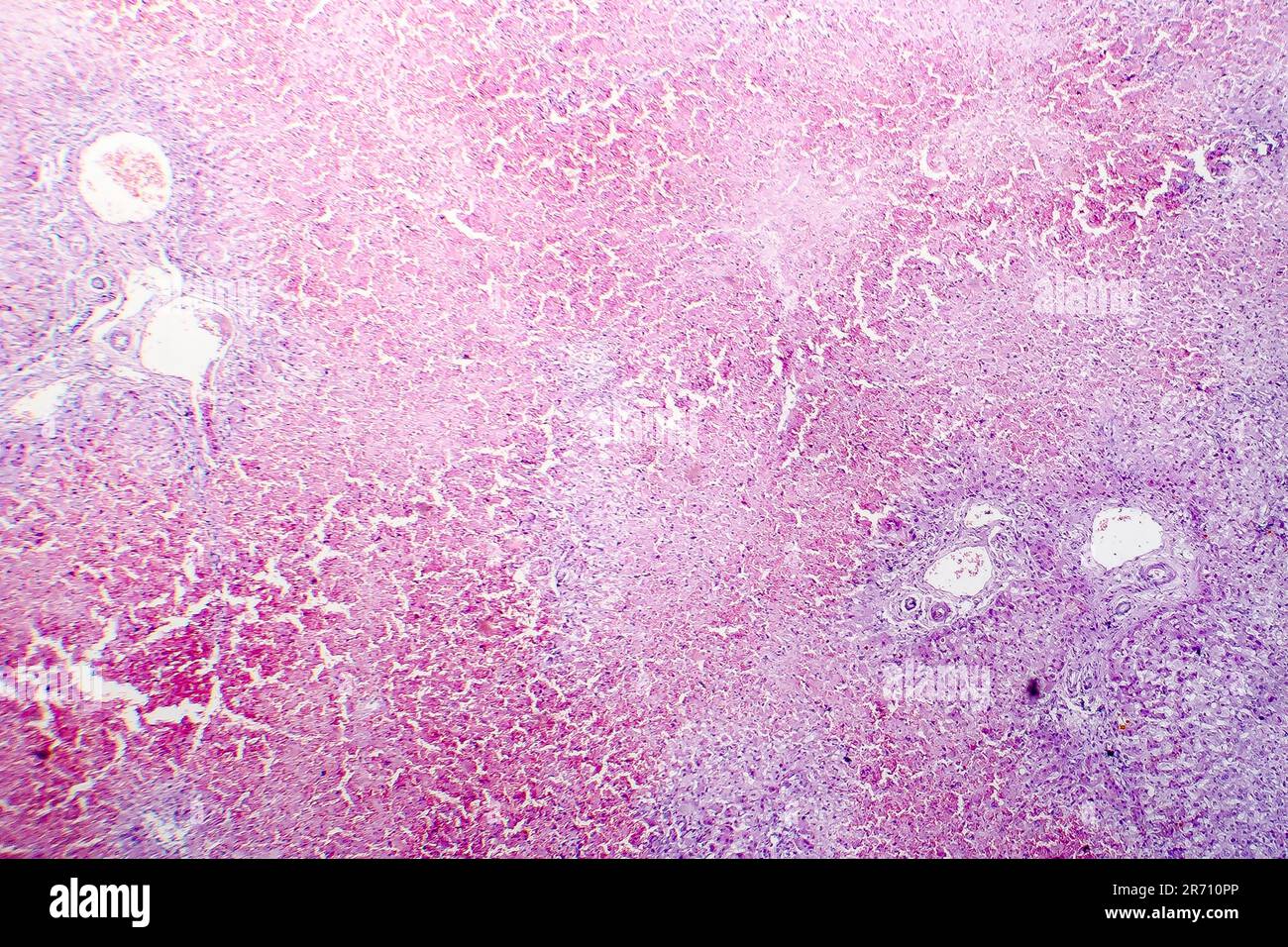 Chronic hepatic congestion, light micrograph, a congestion caused by ...