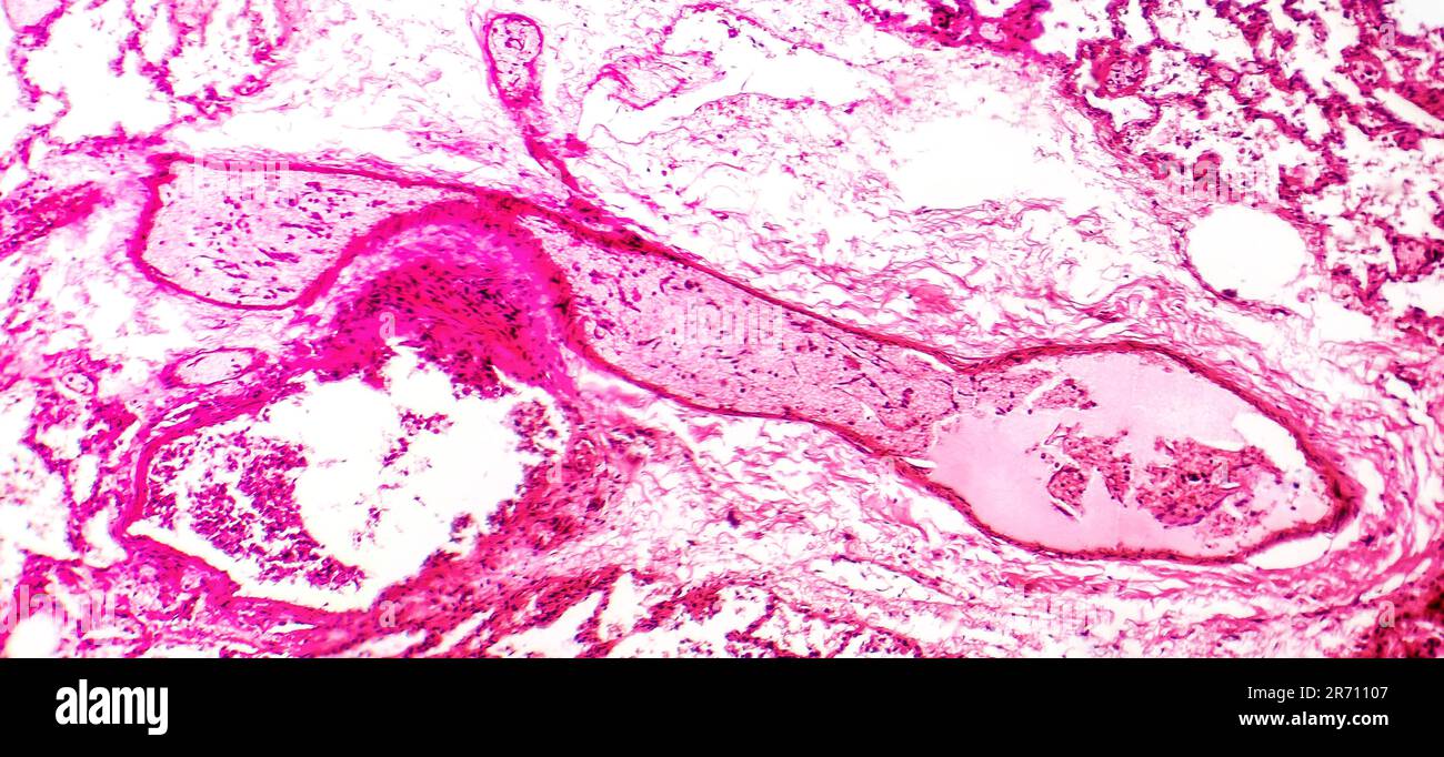 Transparent thrombosis, light micrograph, hematoxylin and eosin ...