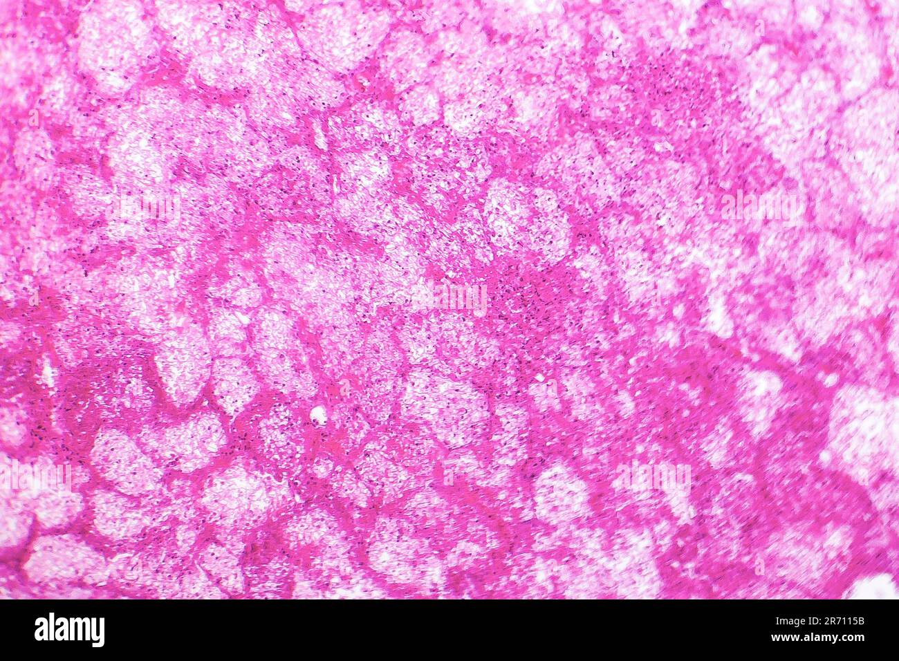 Histopathology of pulmonary hemorrhagic infarct, light micrograph Stock ...