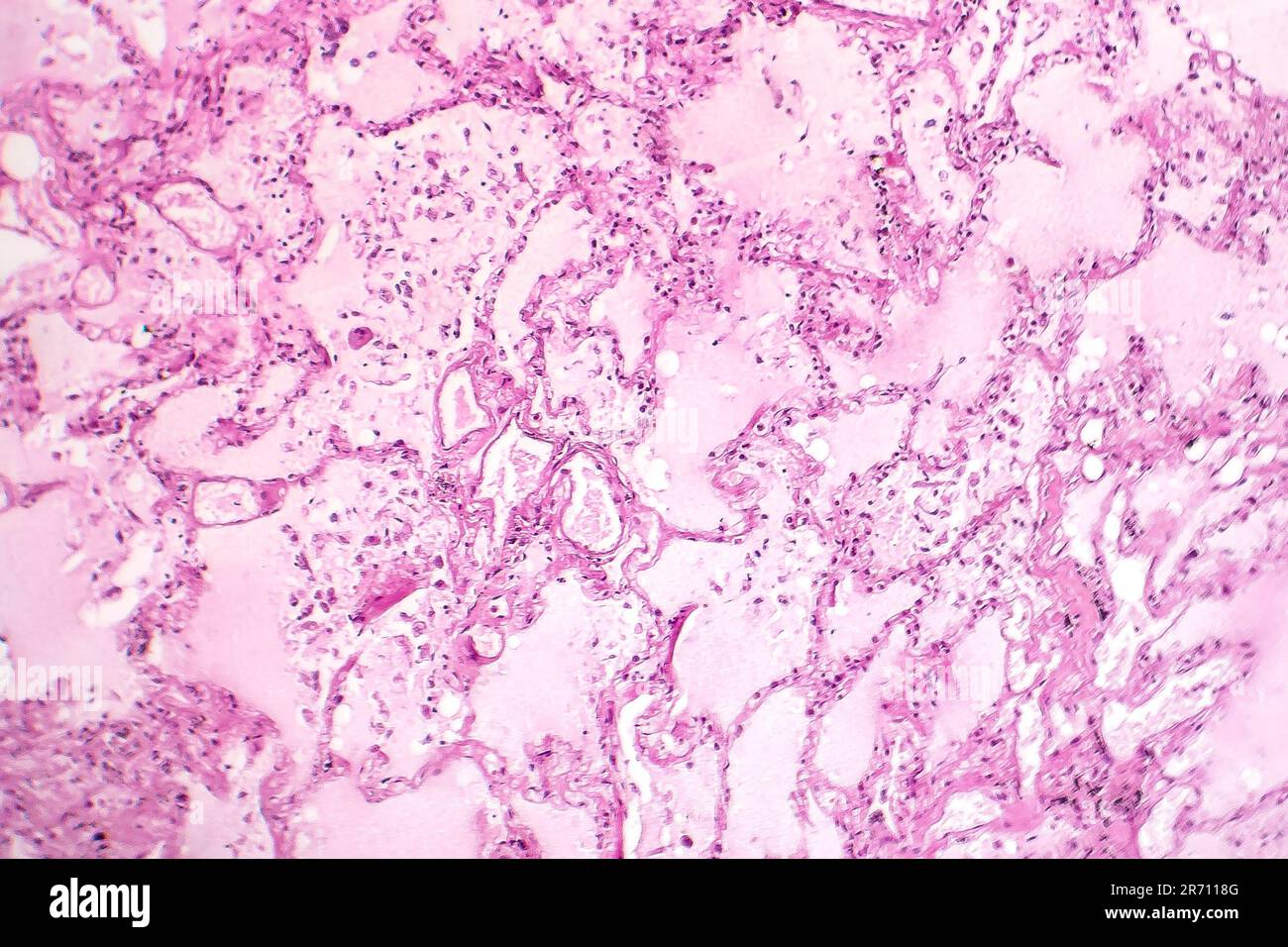 Pulmonary Edema Histology Com702 1 04.gif