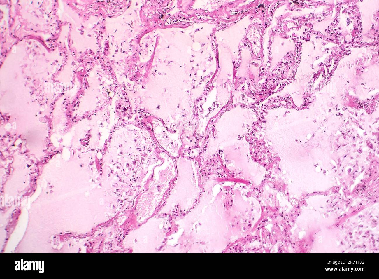 Histopathology of acute pulmonary edema, light micrograph showing ...