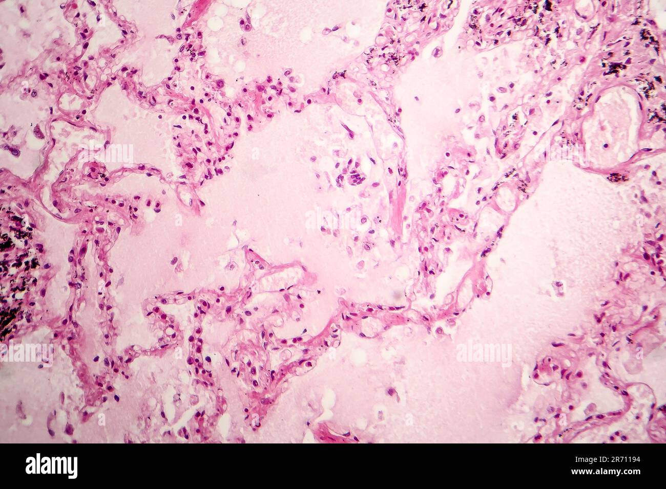 Histopathology of acute pulmonary edema, light micrograph showing ...