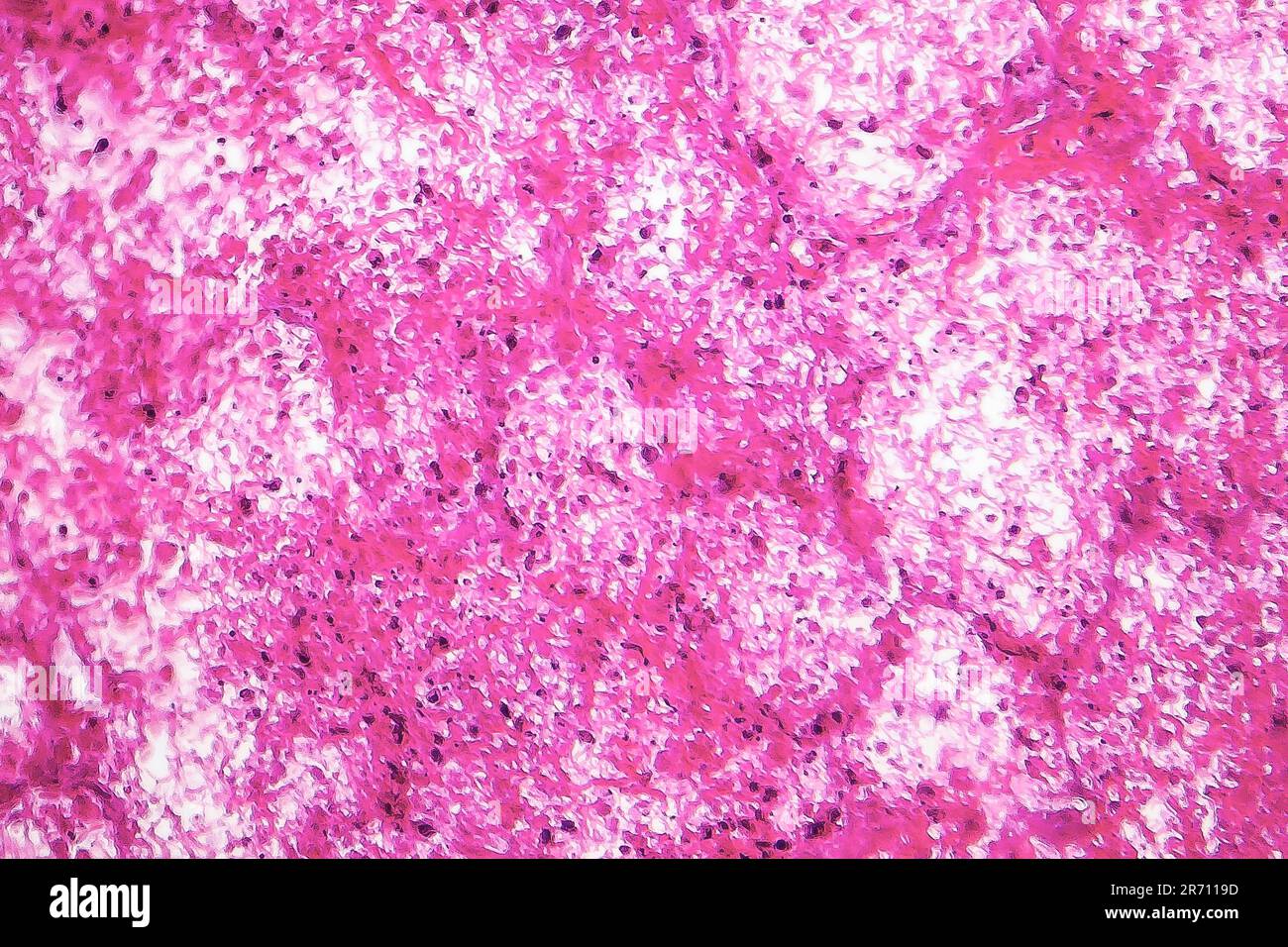 Histopathology of pulmonary hemorrhagic infarct, light micrograph Stock ...
