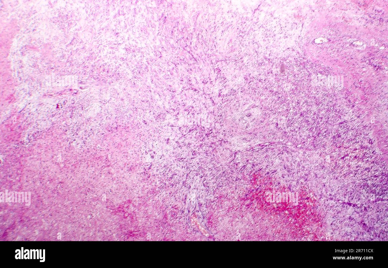 Splenic infarction, light micrograph, photo under microscope Stock ...