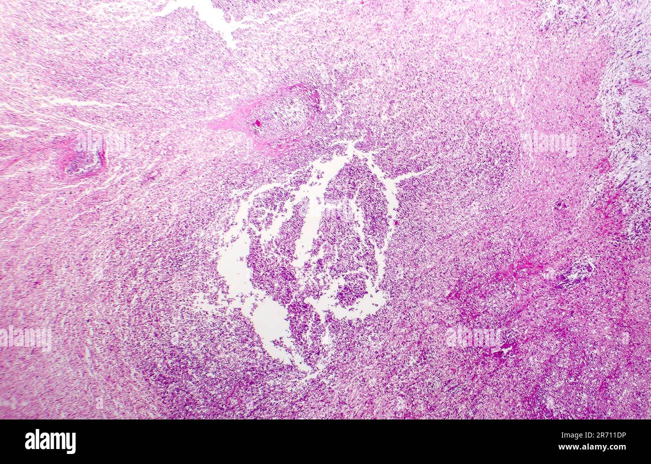 Splenic infarction, light micrograph, photo under microscope Stock ...