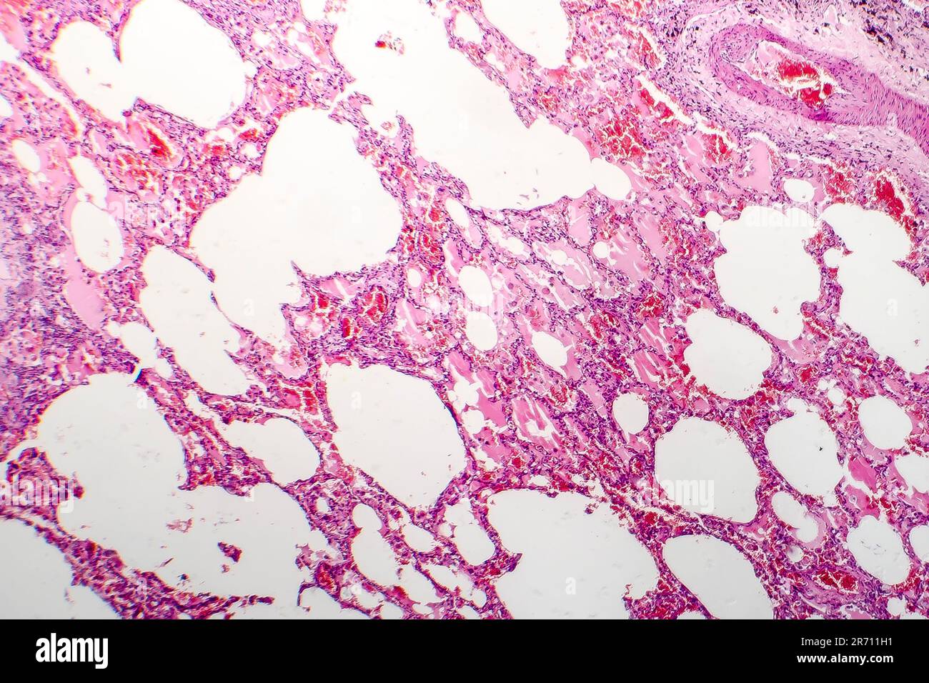 Chronic pulmonary congestion and edema, light micrograph Stock Photo ...