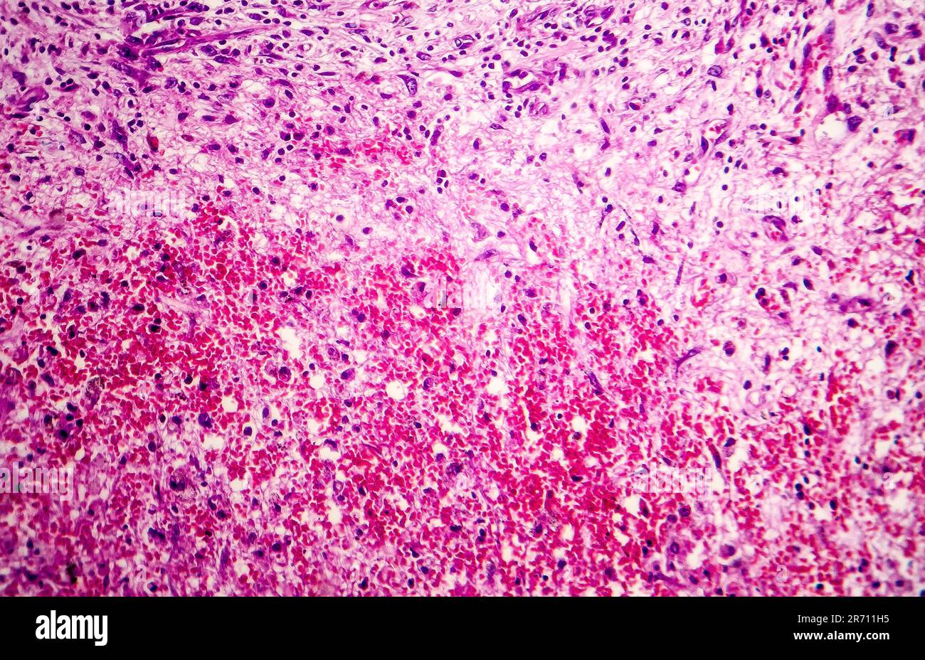 Splenic infarction, light micrograph, photo under microscope Stock ...