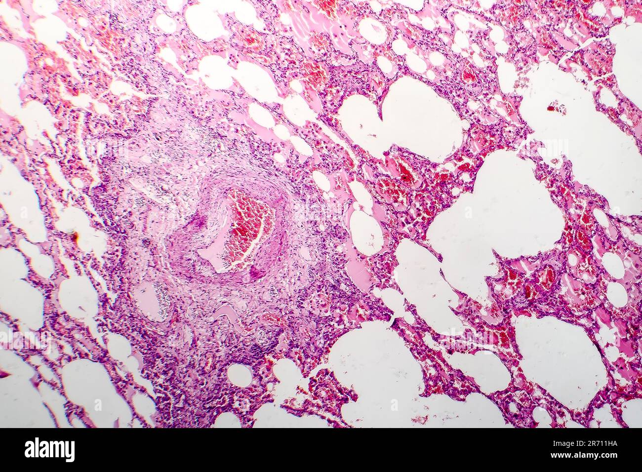 Chronic pulmonary congestion and edema, light micrograph Stock Photo ...