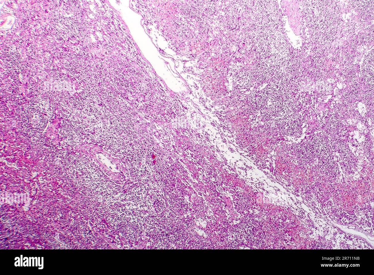 Hemorrhagic lymphadenitits, lymph node inflammation and hemorrhage ...