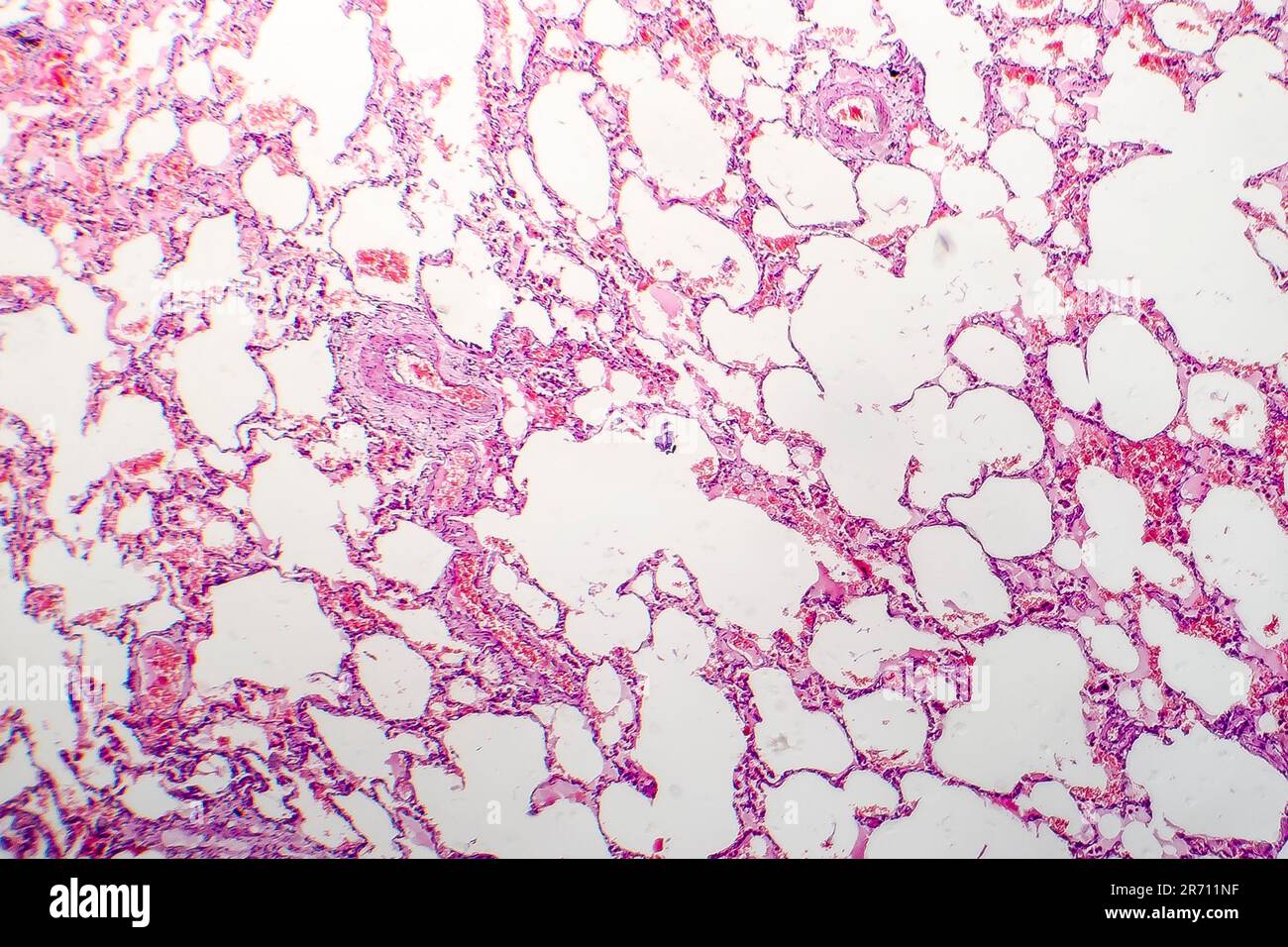 Chronic pulmonary congestion and edema, light micrograph Stock Photo ...