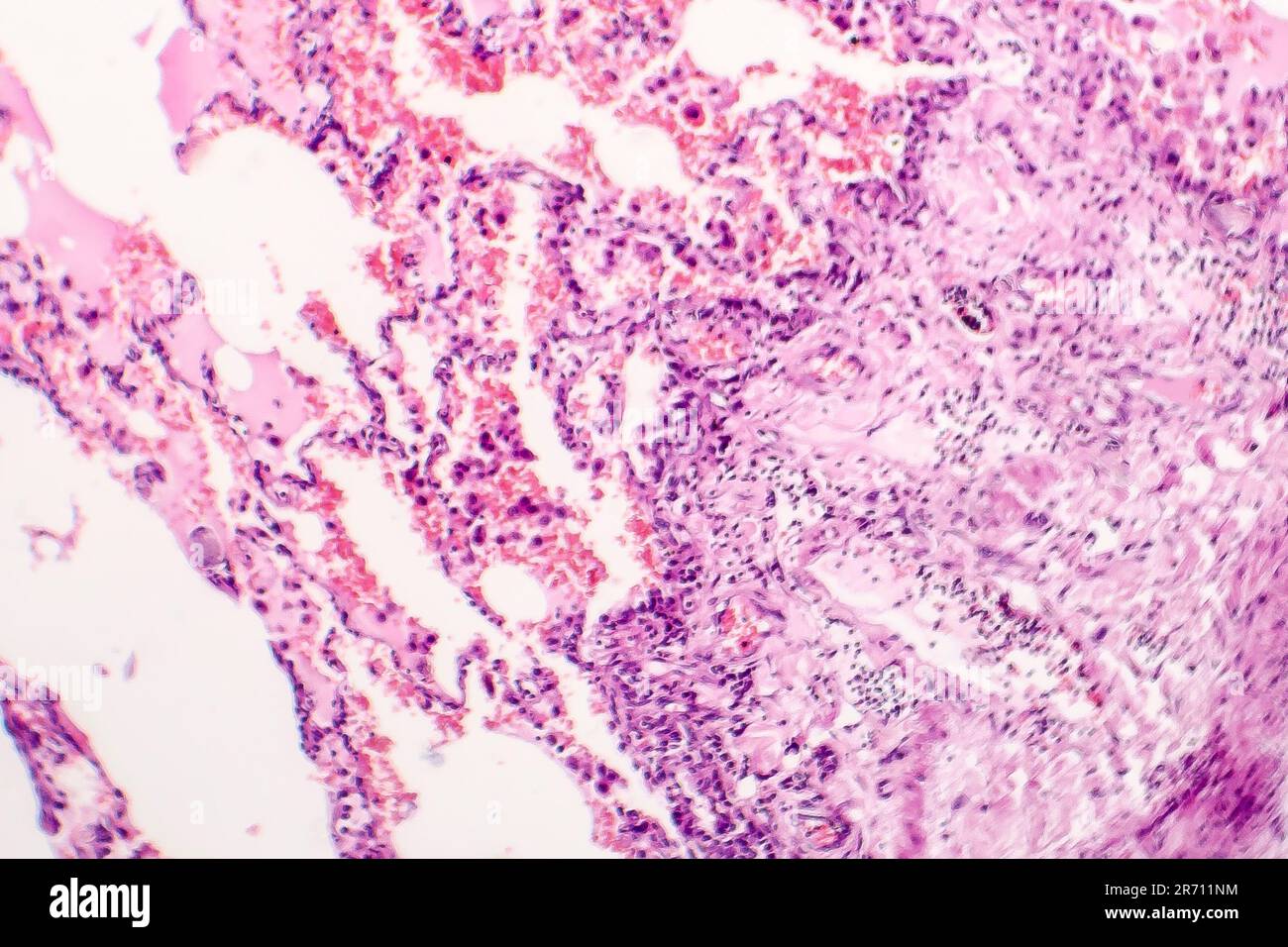Chronic pulmonary congestion and edema, light micrograph Stock Photo ...
