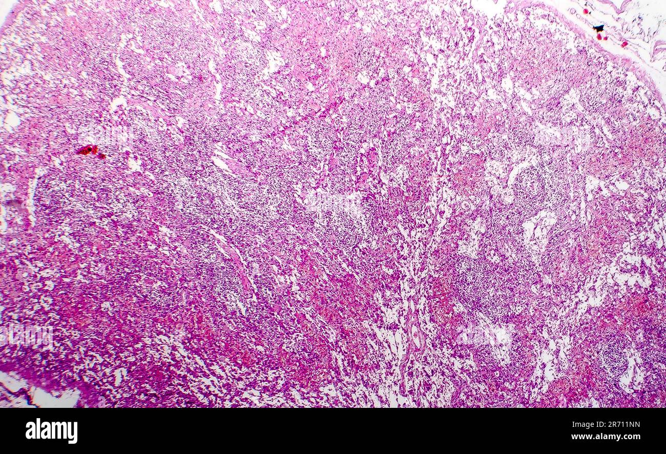 Lymph node micrograph hi-res stock photography and images - Alamy