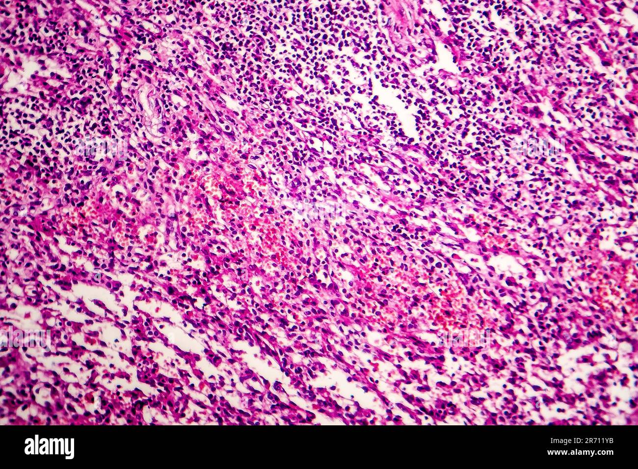 Hemorrhagic lymphadenitits, lymph node inflammation and hemorrhage ...