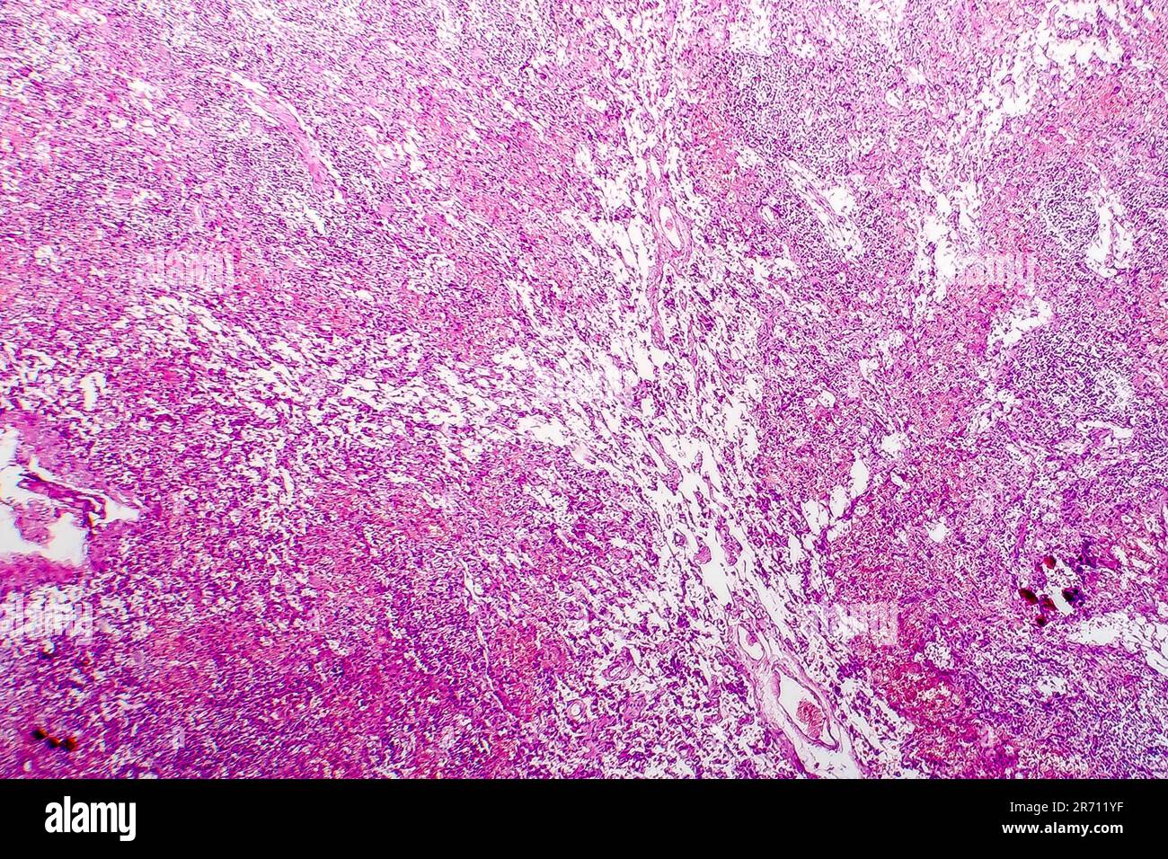 Hemorrhagic lymphadenitits, lymph node inflammation and hemorrhage ...