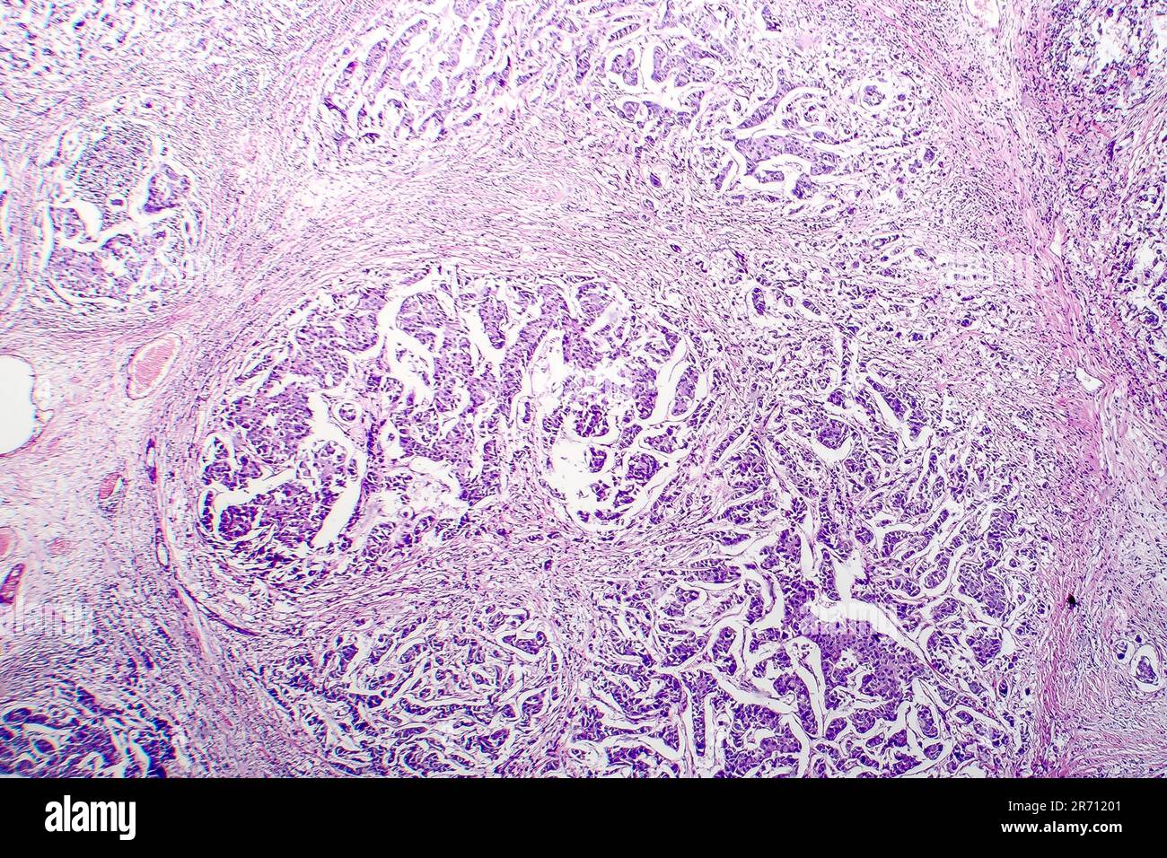 Lymph node cancer, light micrograph, photo under microscope Stock Photo ...