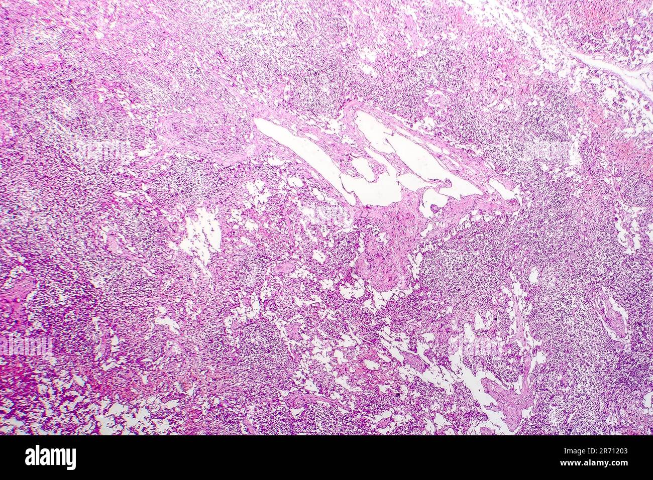 Hemorrhagic lymphadenitits, lymph node inflammation and hemorrhage ...