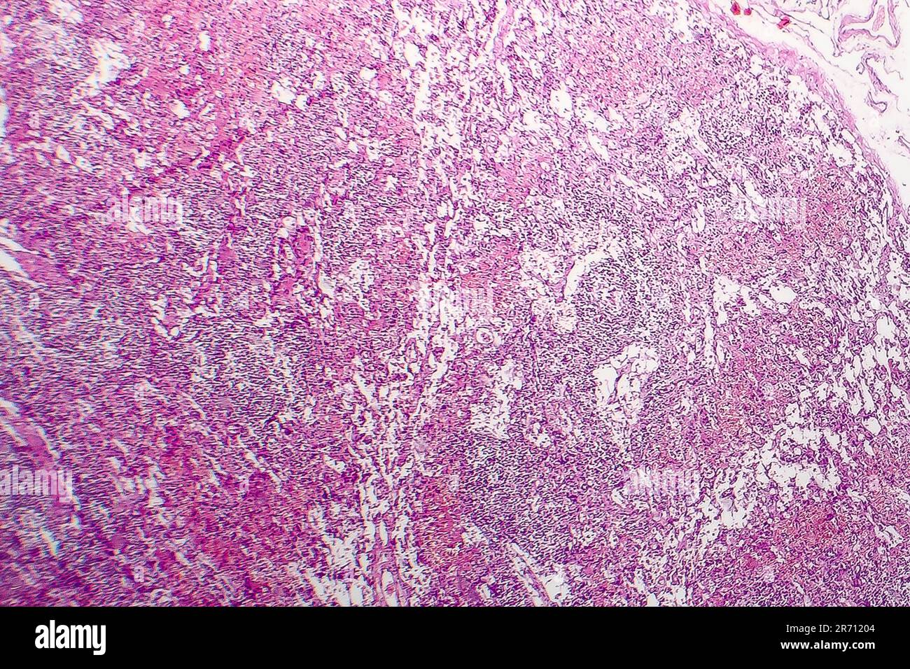 Hemorrhagic lymphadenitits, lymph node inflammation and hemorrhage ...