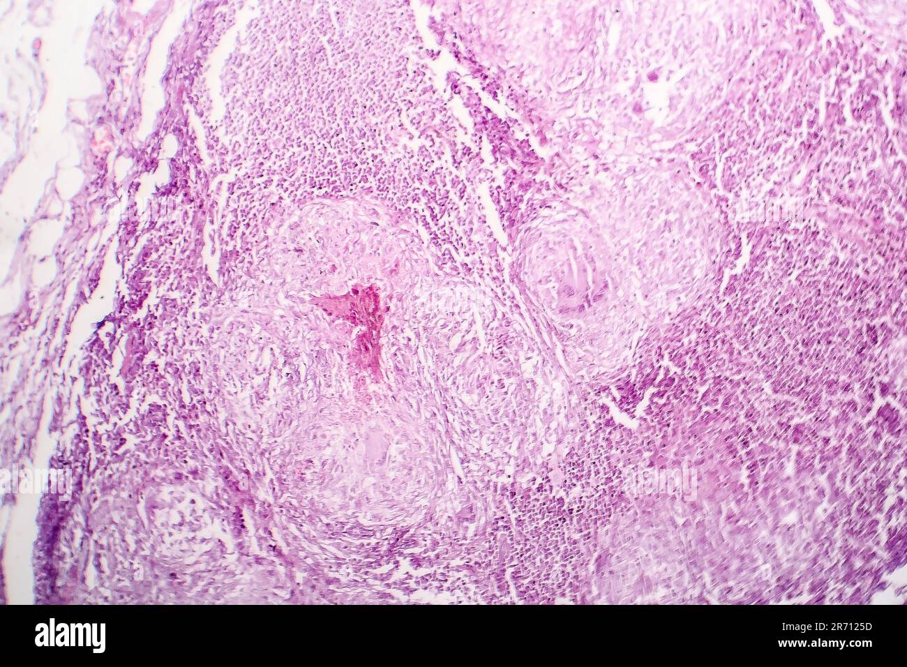 Histopathology of lymph nodal tuberculosis, light micrograph ...
