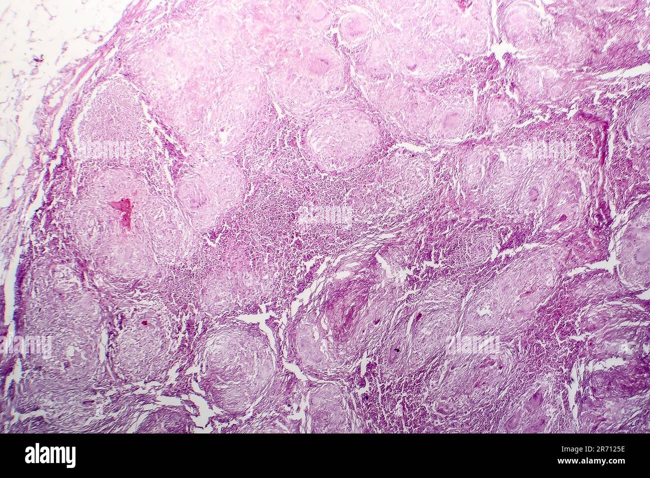 Histopathology of lymph nodal tuberculosis, light micrograph ...