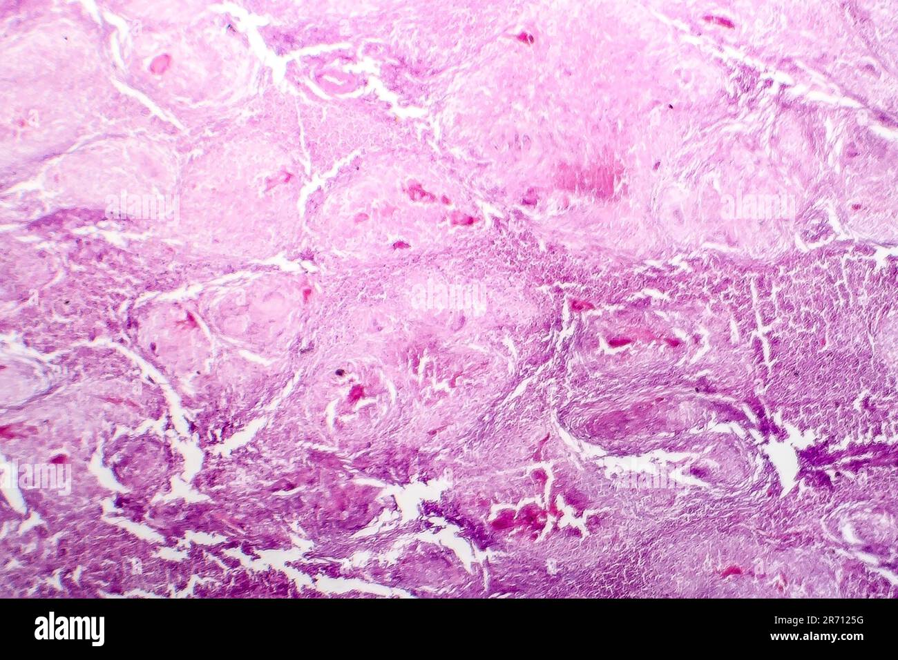 Histopathology of lymph nodal tuberculosis, light micrograph ...