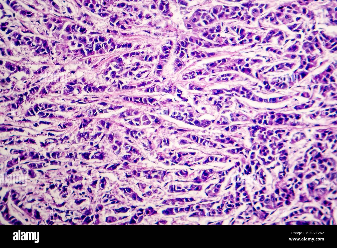 Lymph node cancer, light micrograph, photo under microscope Stock Photo ...