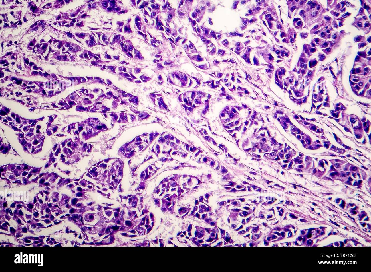 Lymph node cancer, light micrograph, photo under microscope Stock Photo ...