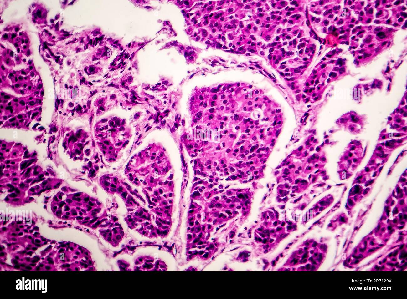 Lymph node metastasis, light micrograph of cancer that has spread to a ...