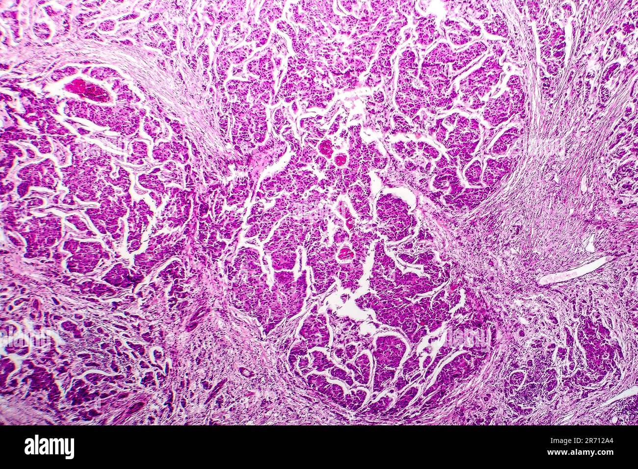 Lymph Node Metastasis Light Micrograph Of Cancer That Has Spread To A