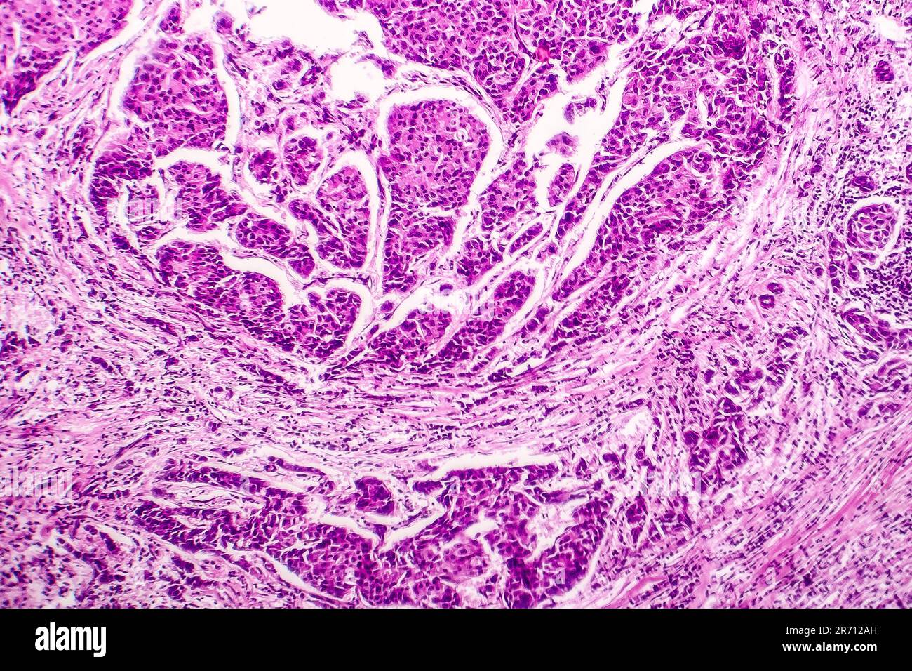 Lymph node metastasis, light micrograph of cancer that has spread to a ...