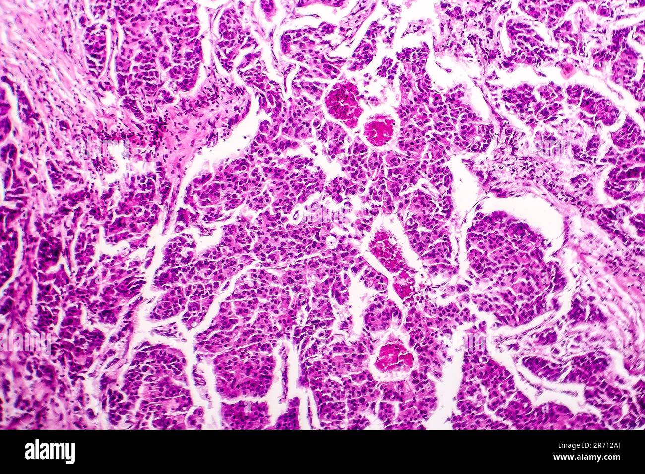 Lymph node micrograph hi-res stock photography and images - Alamy