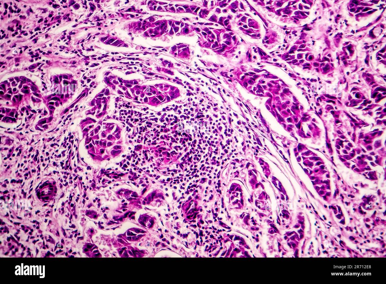 Lymph node metastasis, light micrograph of cancer that has spread to a ...