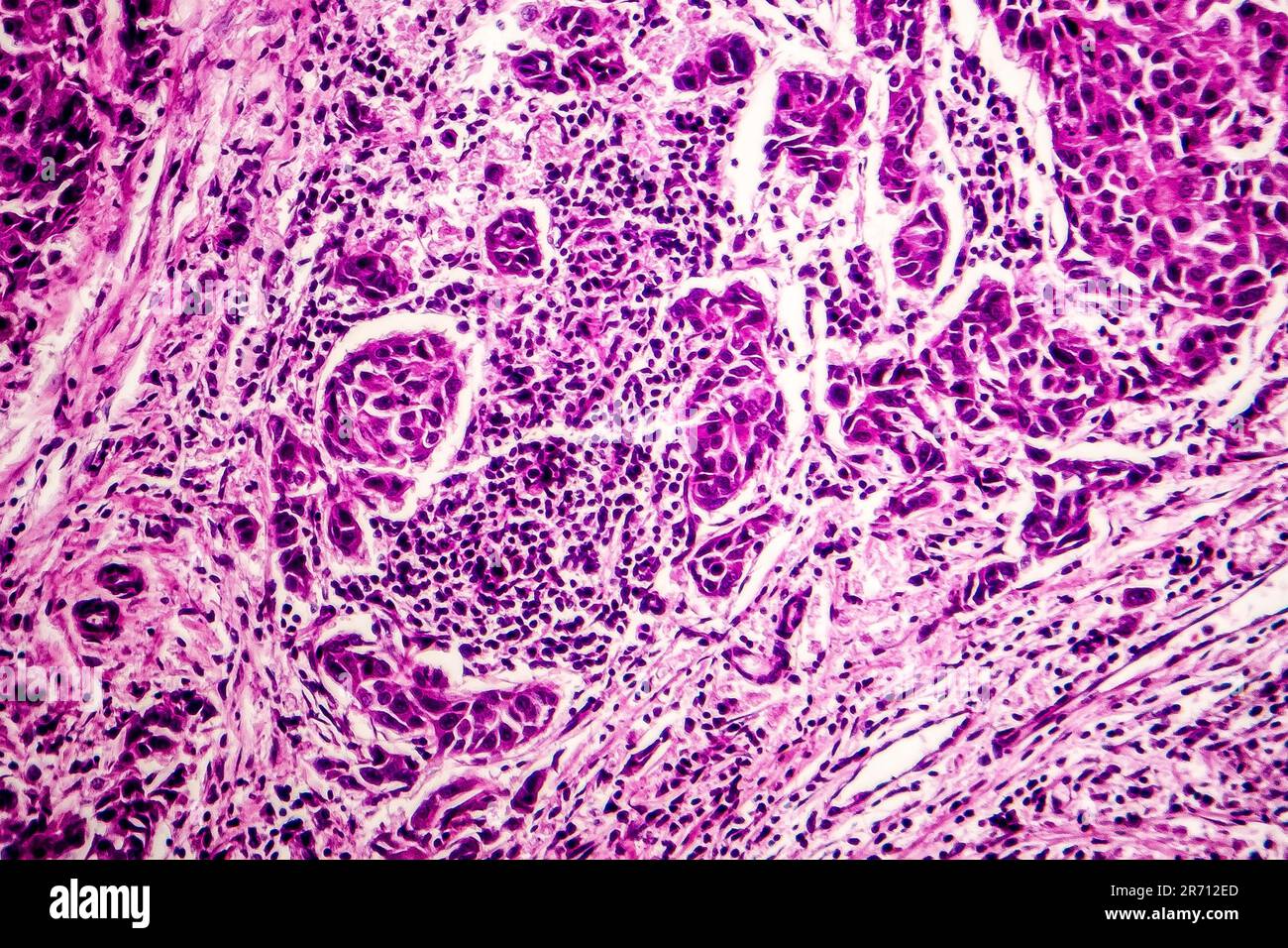 Lymph node metastasis, light micrograph of cancer that has spread to a ...