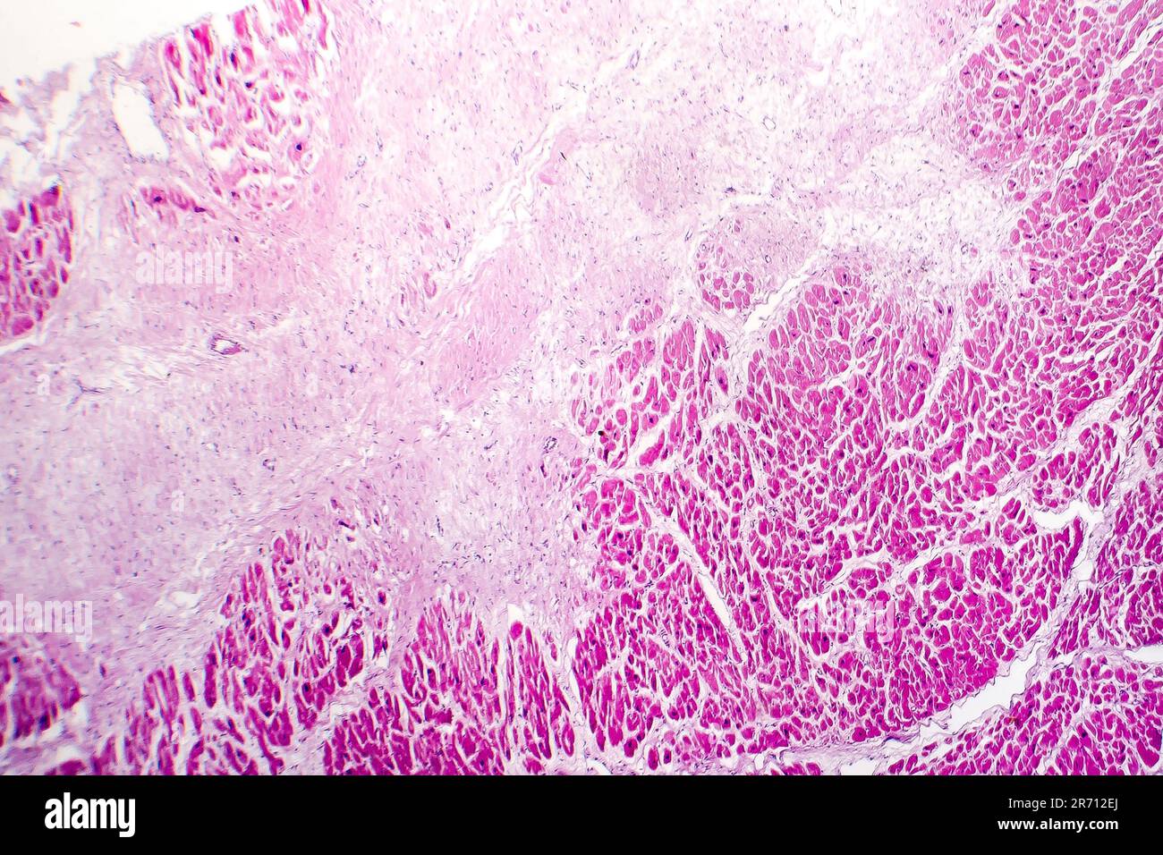Acute myocardial infarction, histology of heart tissue, light ...