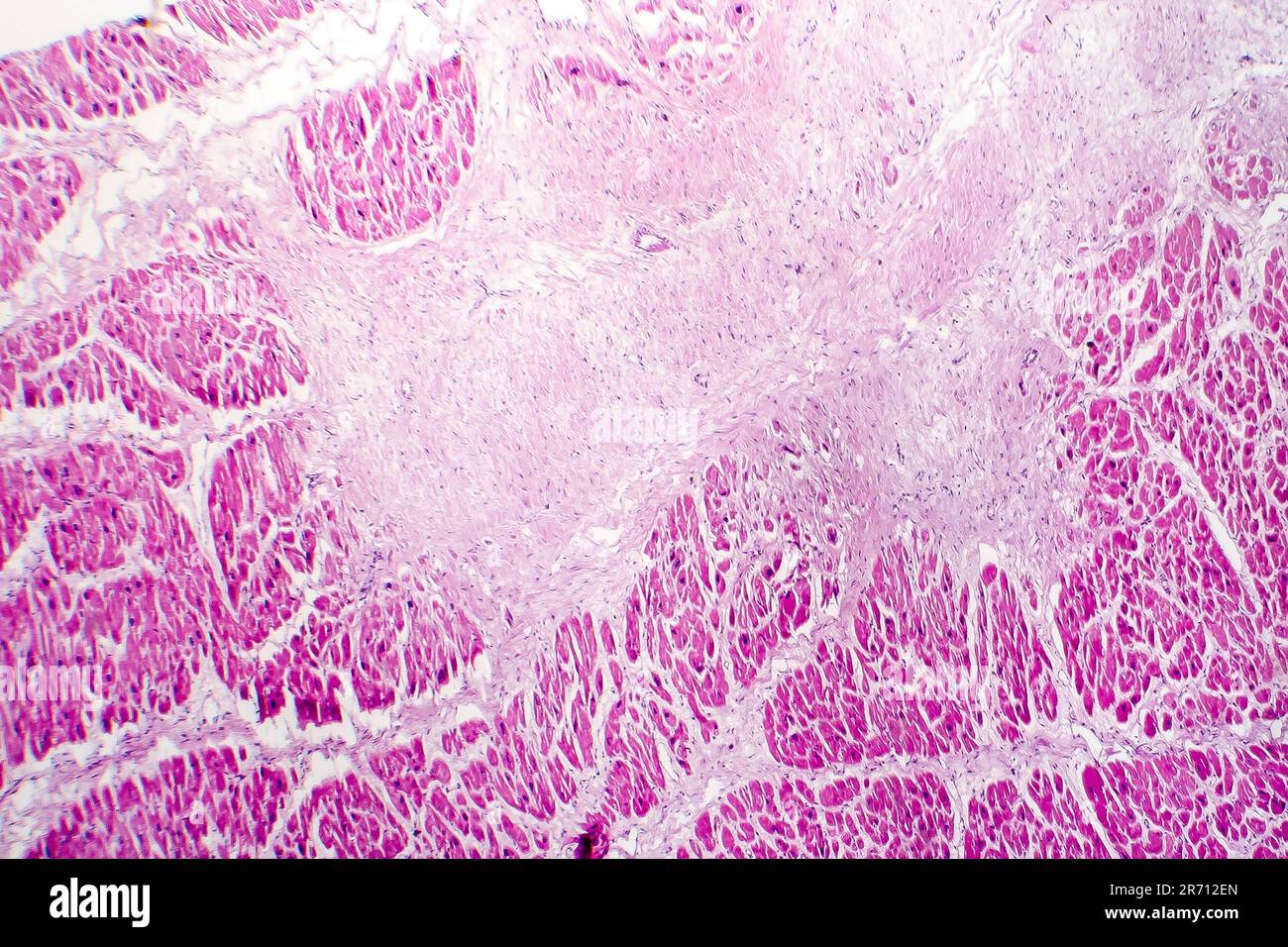 Acute myocardial infarction, histology of heart tissue, light ...