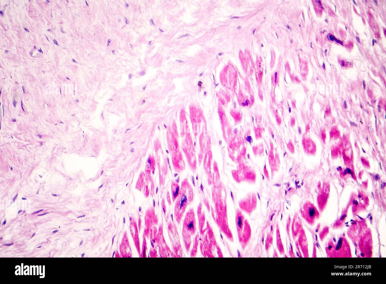 Acute myocardial infarction, histology of heart tissue, light ...